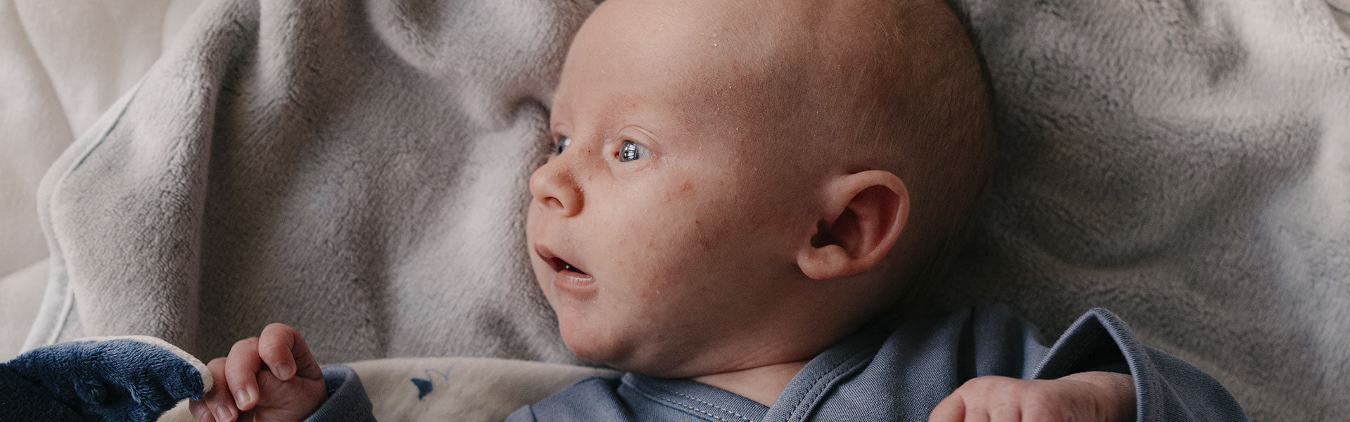 Alles over kinderziekten: waterpokken of windpokken – Dreambaby